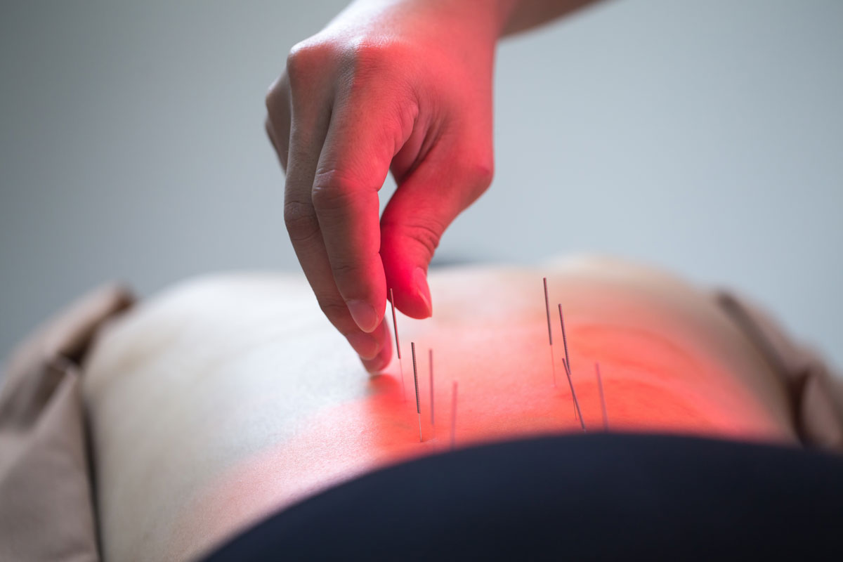 Dry Needling – The Muscle Doc Method